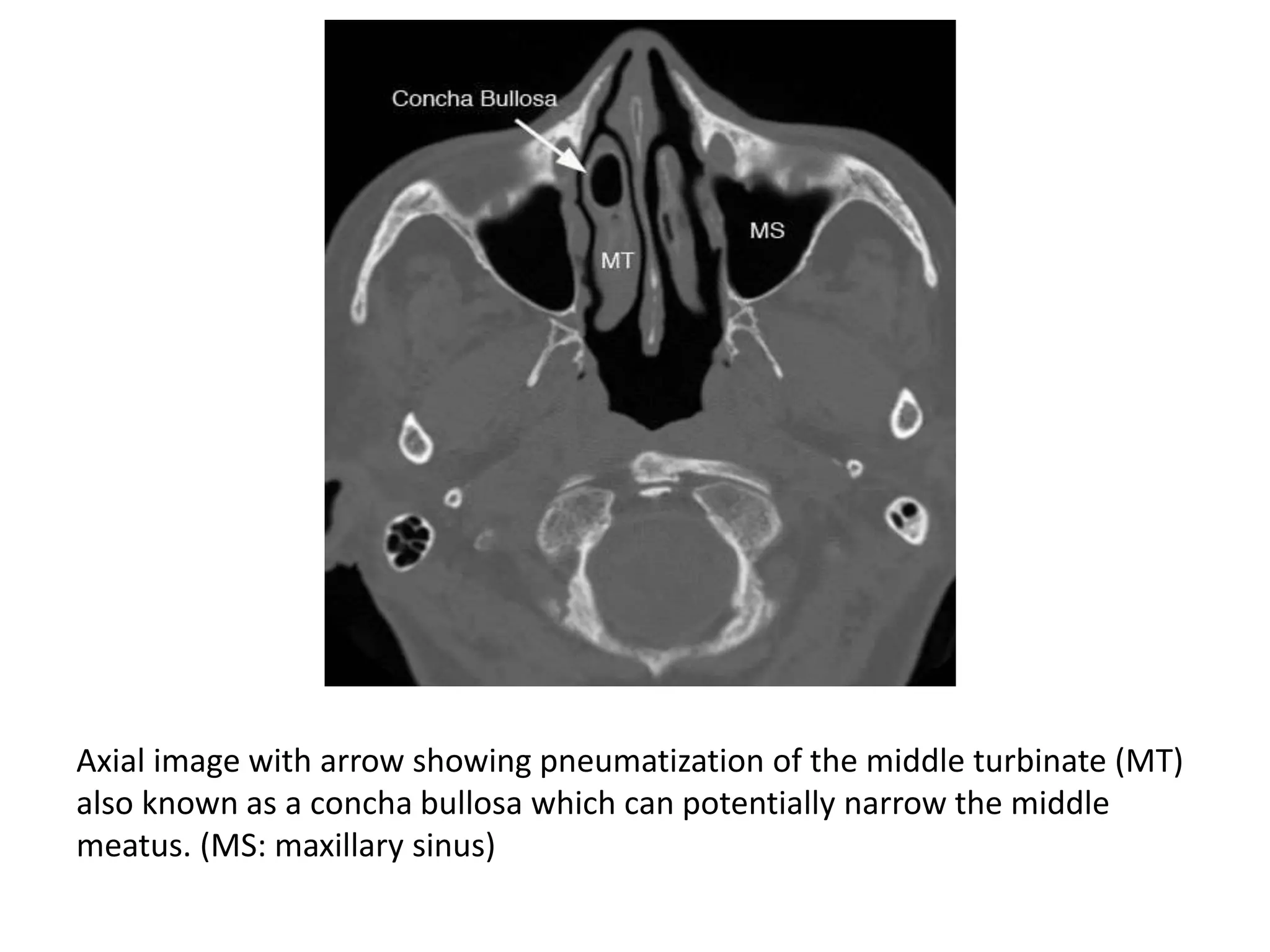 IMAGING OF PARANASAL SINUSES.ppt