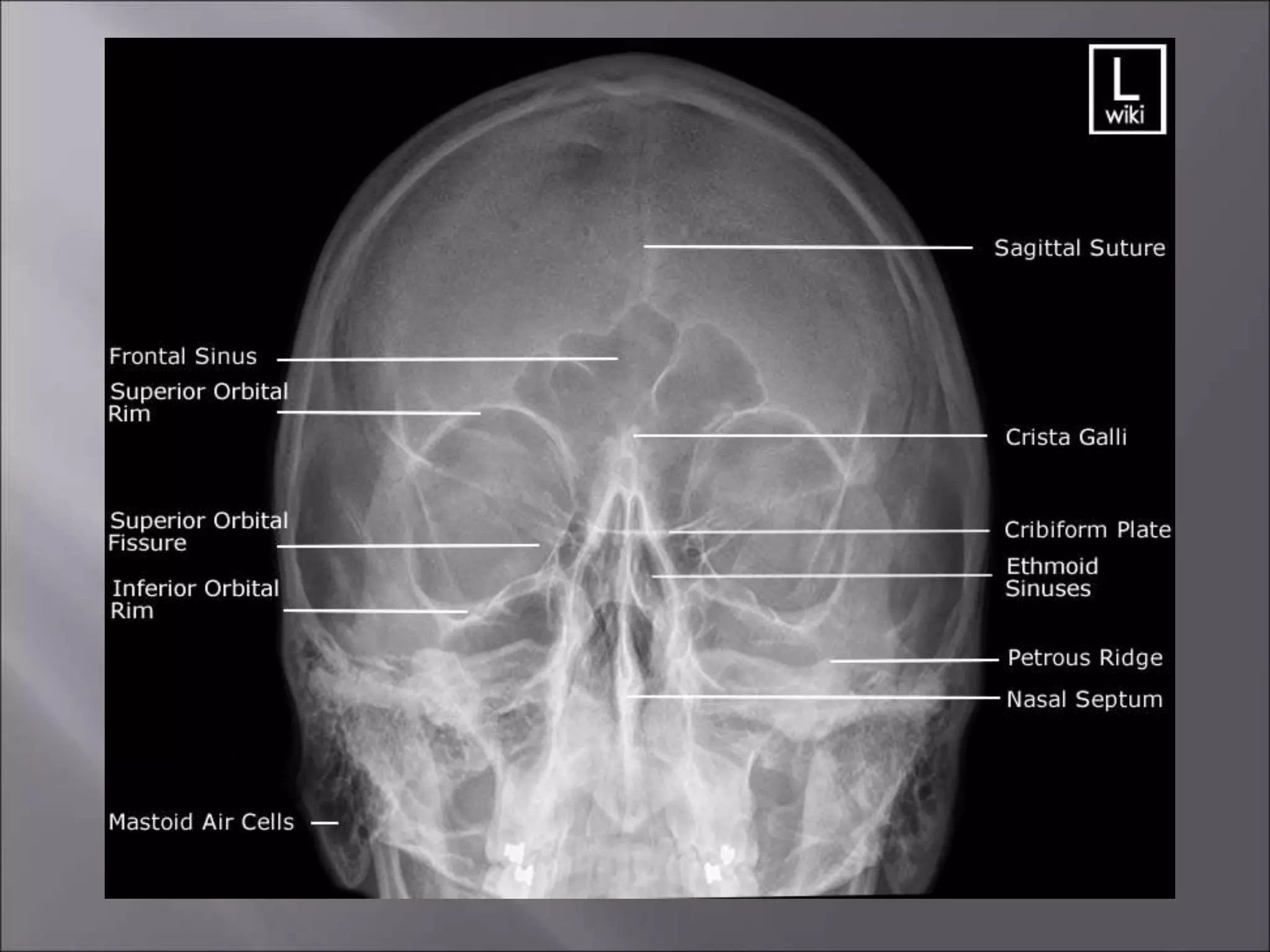 IMAGING OF PARANASAL SINUSES.ppt