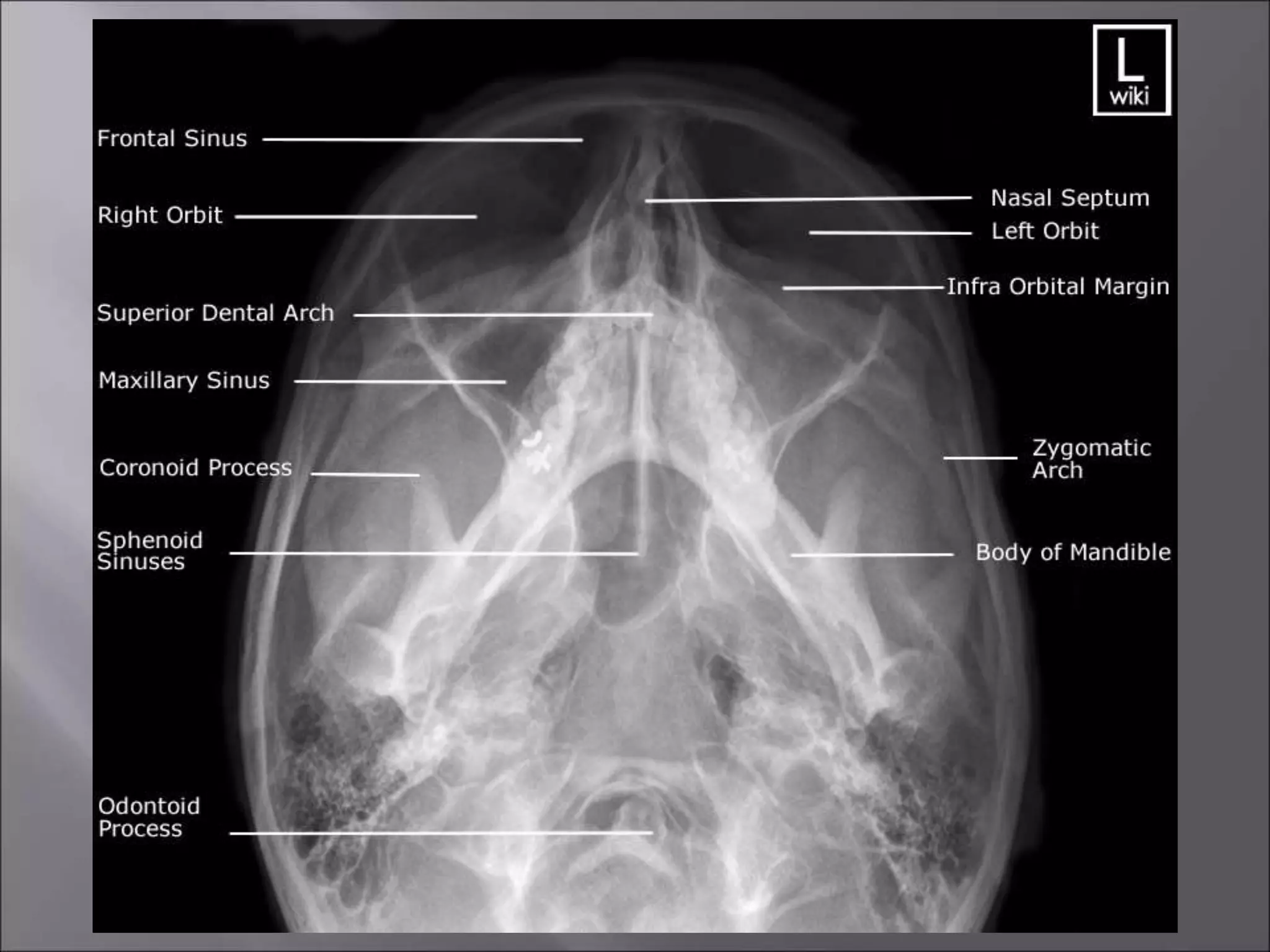 IMAGING OF PARANASAL SINUSES.ppt