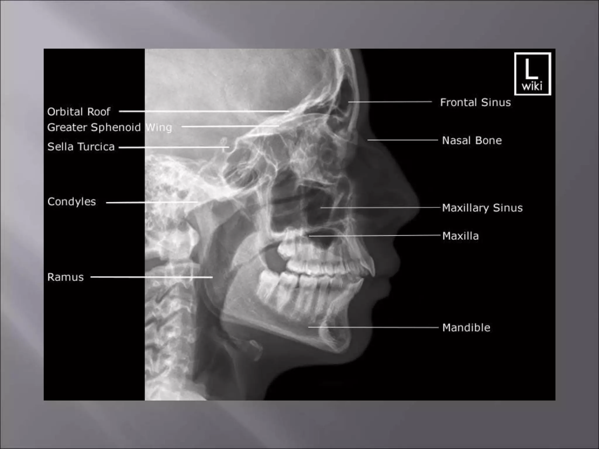 IMAGING OF PARANASAL SINUSES.ppt