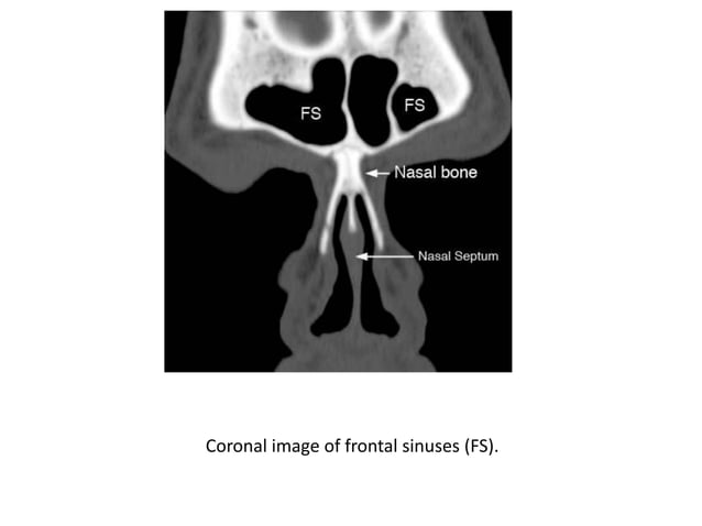 IMAGING OF PARANASAL SINUSES.ppt