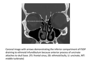 IMAGING OF PARANASAL SINUSES.ppt