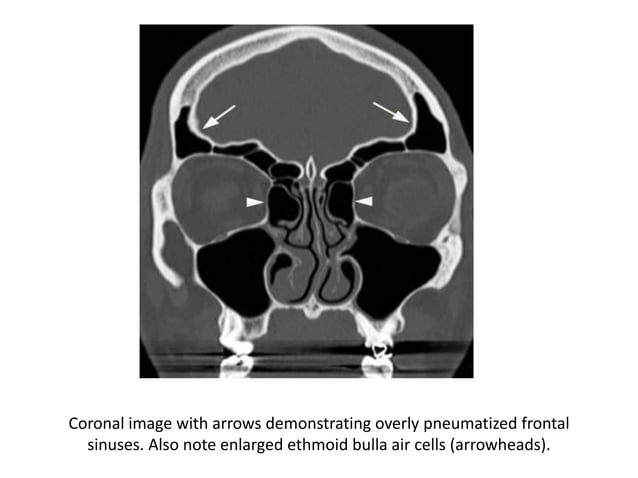 IMAGING OF PARANASAL SINUSES.ppt