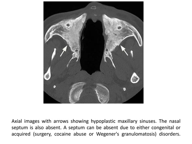 IMAGING OF PARANASAL SINUSES.ppt