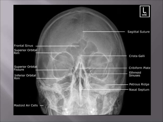 IMAGING OF PARANASAL SINUSES.ppt