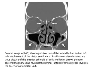 IMAGING OF PARANASAL SINUSES.ppt