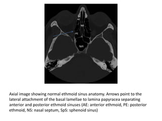 IMAGING OF PARANASAL SINUSES.ppt