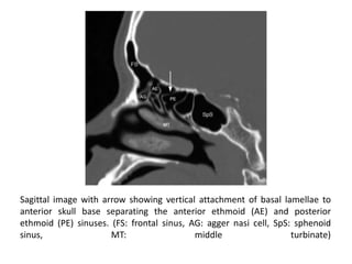 IMAGING OF PARANASAL SINUSES.ppt