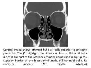 IMAGING OF PARANASAL SINUSES.ppt