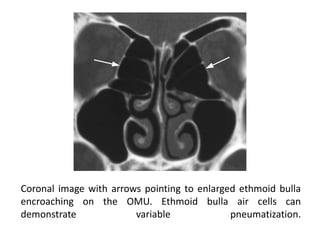 IMAGING OF PARANASAL SINUSES.ppt