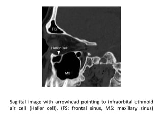 IMAGING OF PARANASAL SINUSES.ppt
