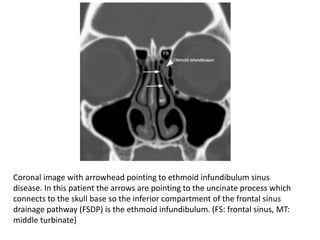 IMAGING OF PARANASAL SINUSES.ppt