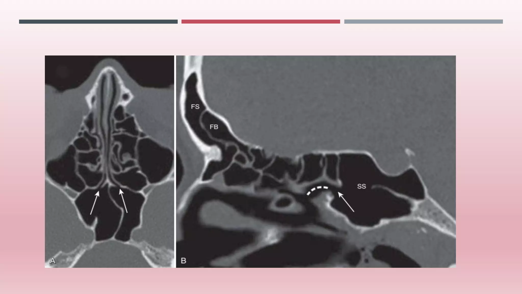 Imaging of paranasal sinuses (including anatomy and varaints)pk1 pdf ...