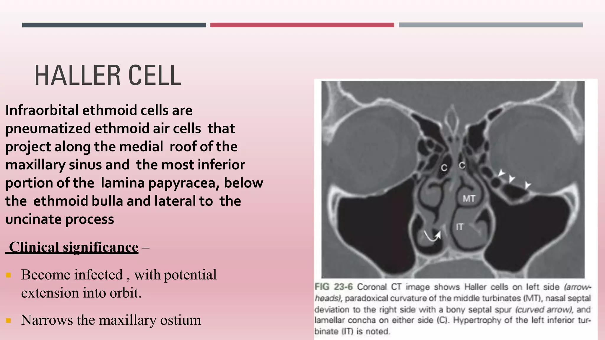 Imaging of paranasal sinuses (including anatomy and varaints)pk1 pdf ...
