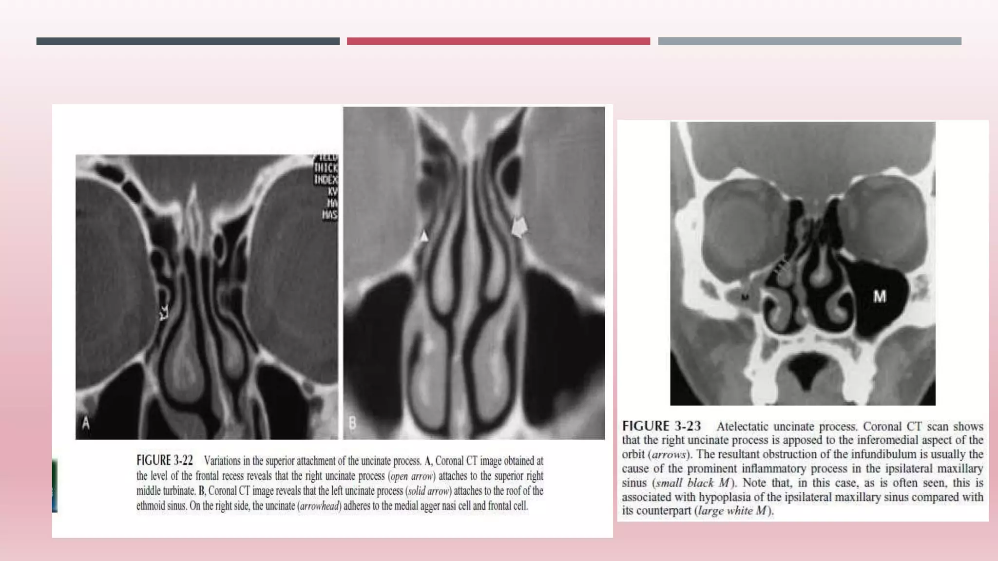 Imaging of paranasal sinuses (including anatomy and varaints)pk1 pdf ...