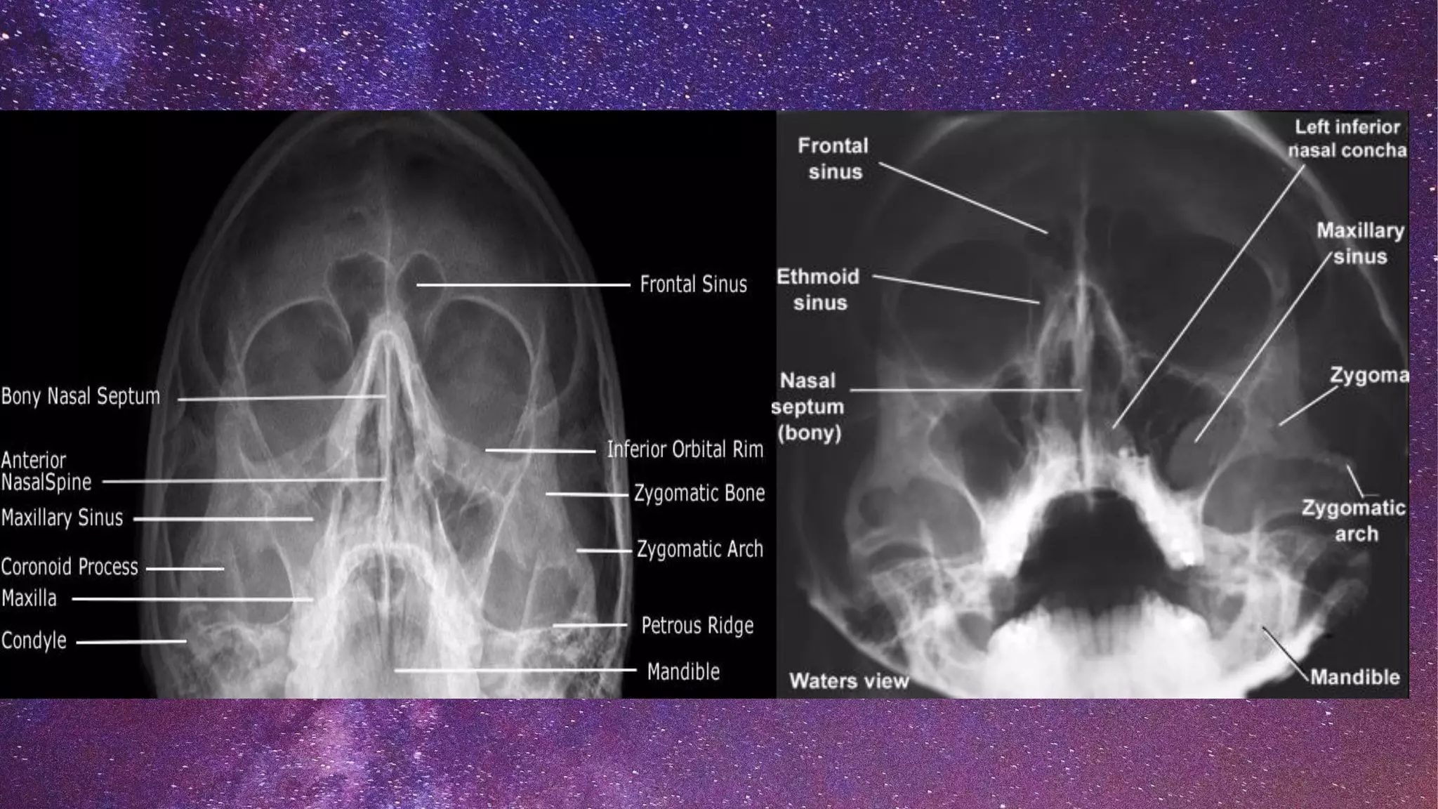 Imaging of paranasal sinuses (including anatomy and varaints)pk1 pdf ...
