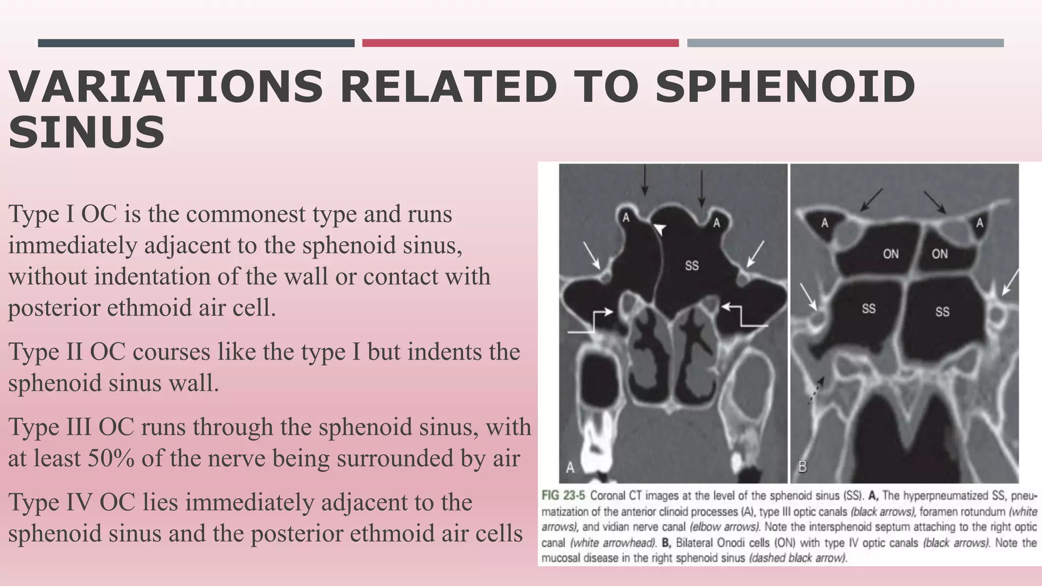 Imaging of paranasal sinuses (including anatomy and varaints)pk1 pdf ...