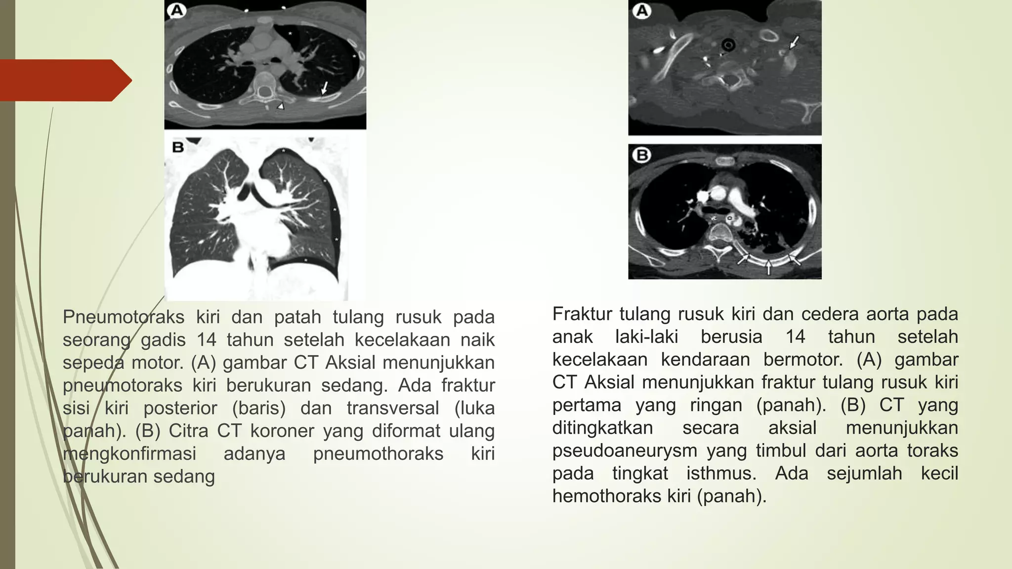 Imaging of pediatric thoracic trauma | PPTX