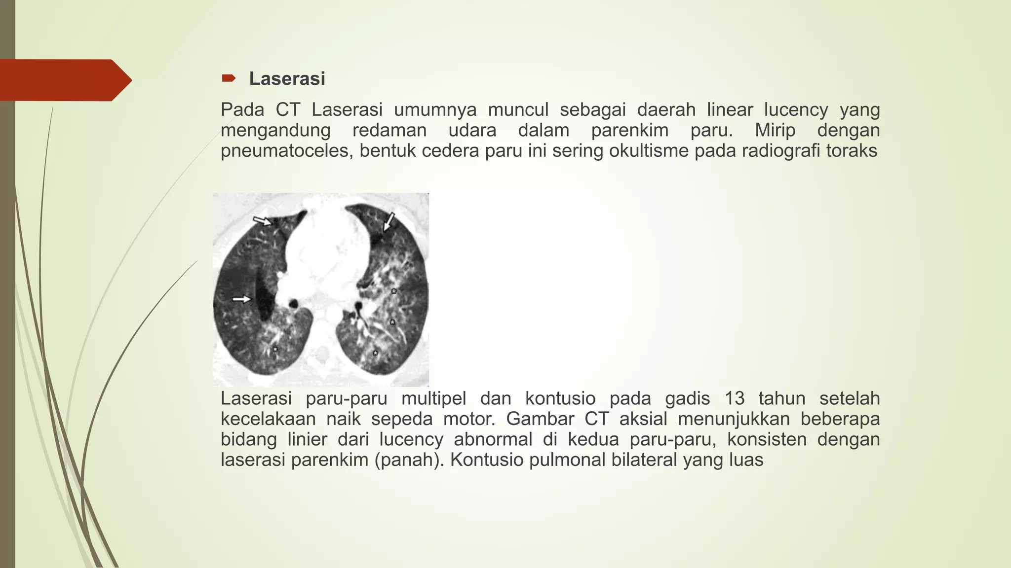 Imaging of pediatric thoracic trauma | PPTX