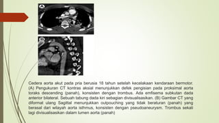 Imaging of pediatric thoracic trauma | PPTX