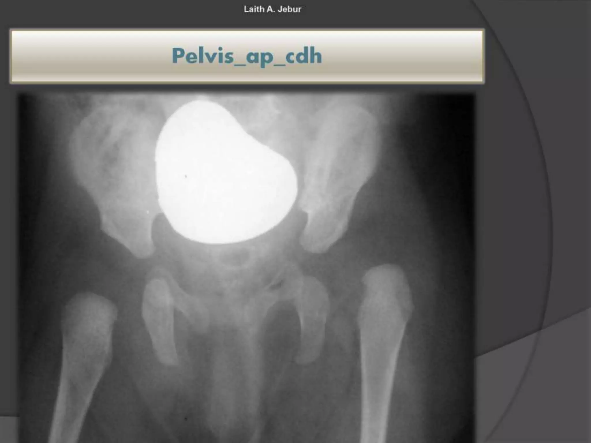 Imaging of pelvic diseases | PPT