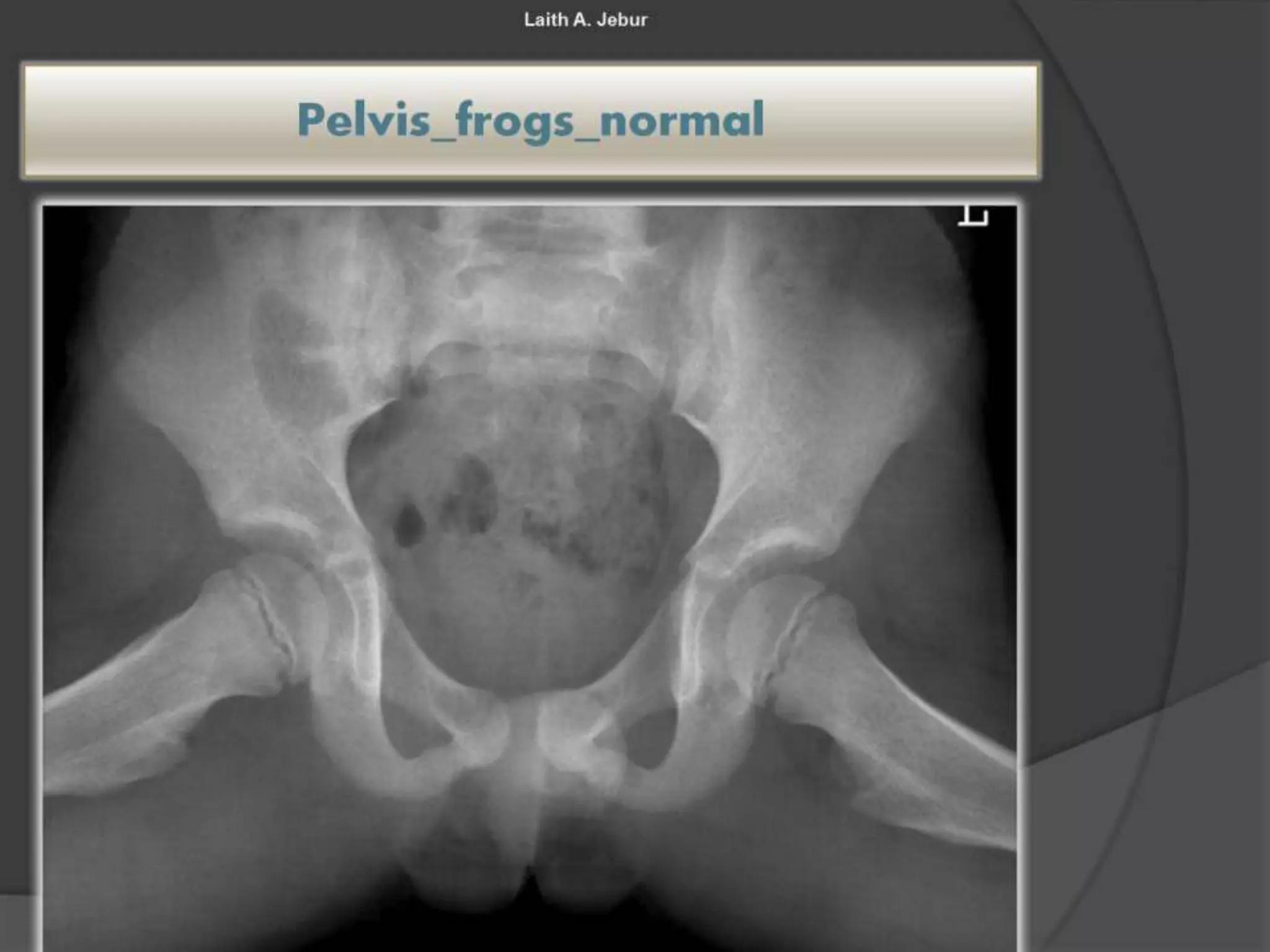 Imaging of pelvic diseases | PPT