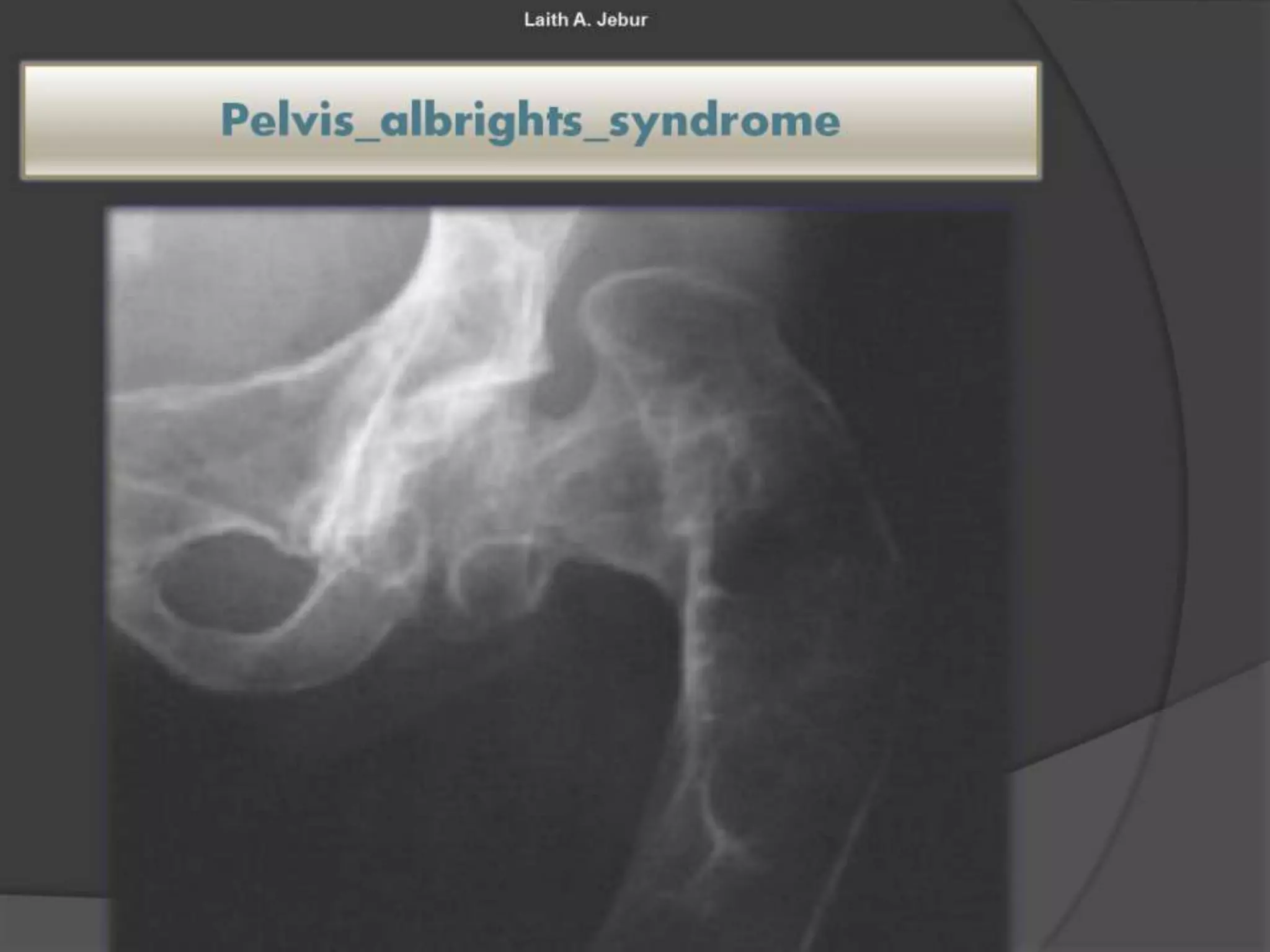 Imaging of pelvic diseases | PPT
