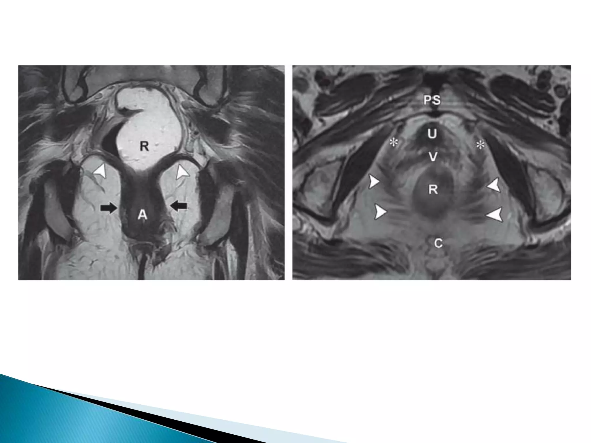 Imaging of pelvic floor weakness | PPTX
