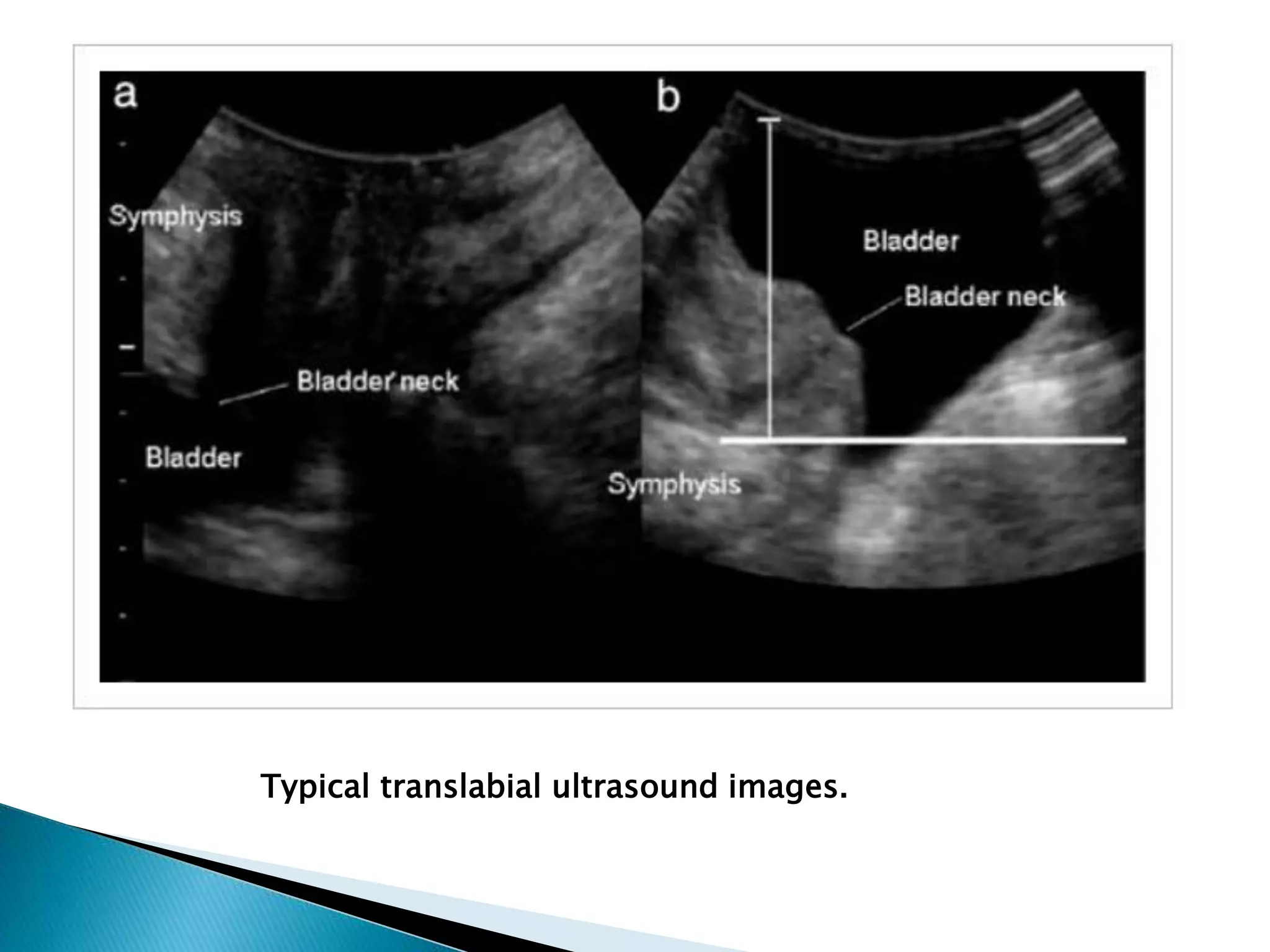 Imaging of pelvic floor weakness | PPTX