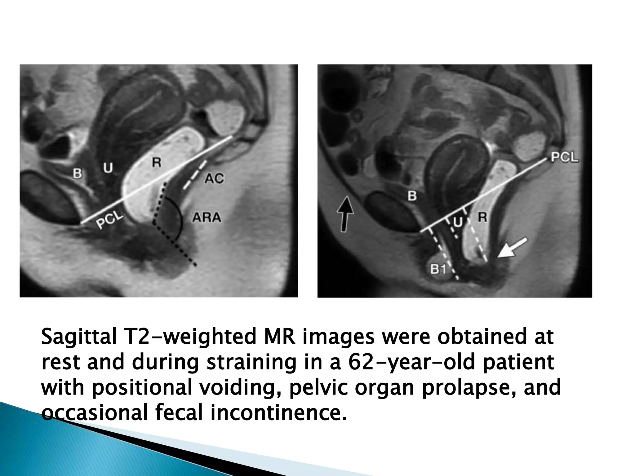 Imaging of pelvic floor weakness | PPTX