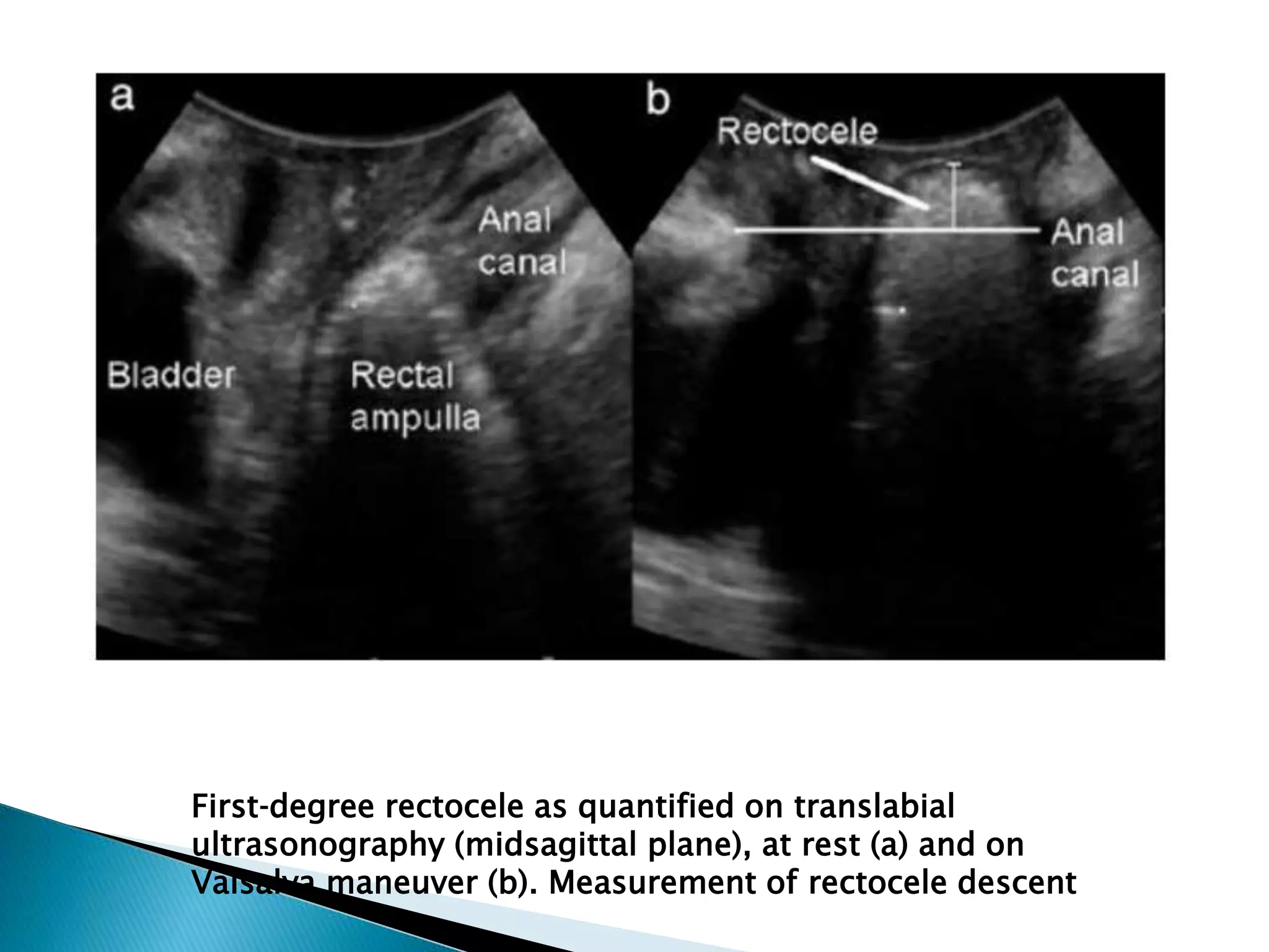 Imaging of pelvic floor weakness | PPTX