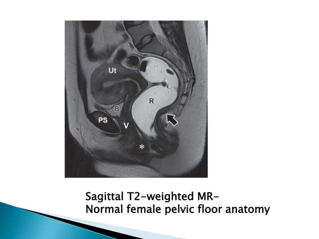 Imaging of pelvic floor weakness | PPTX