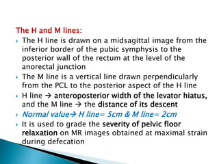 Imaging of pelvic floor weakness | PPTX