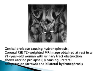 Imaging of pelvic floor weakness | PPTX