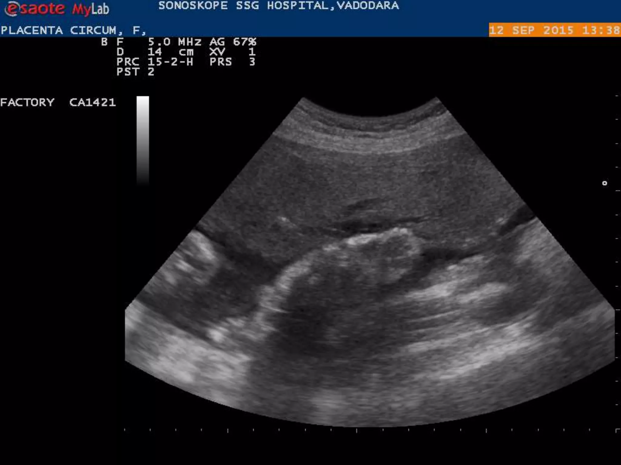 Imaging of placenta | PPTX