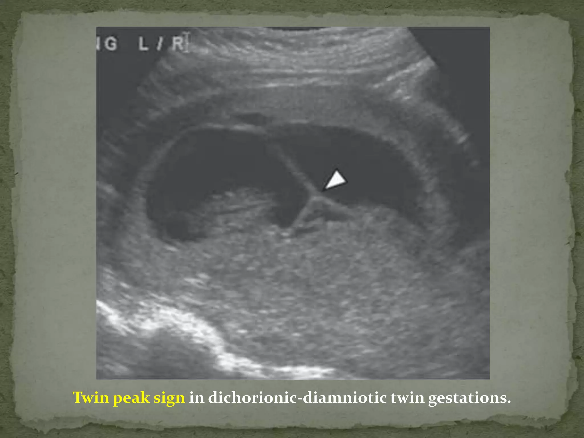 Imaging of placenta | PPTX