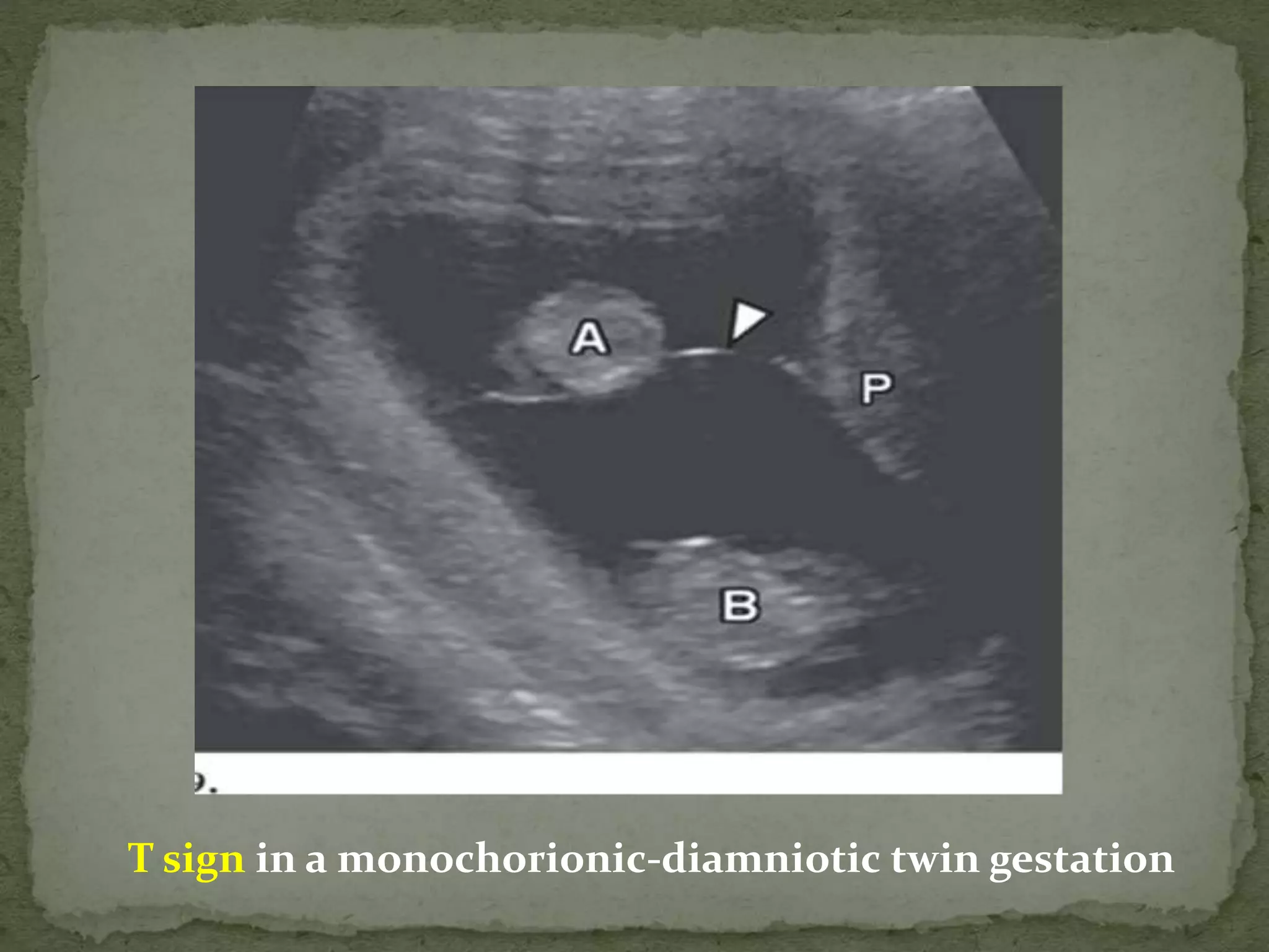 Imaging of placenta | PPTX