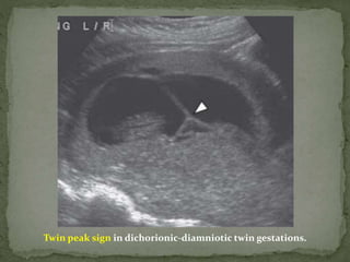 Twin Peaks Sign Ultrasound