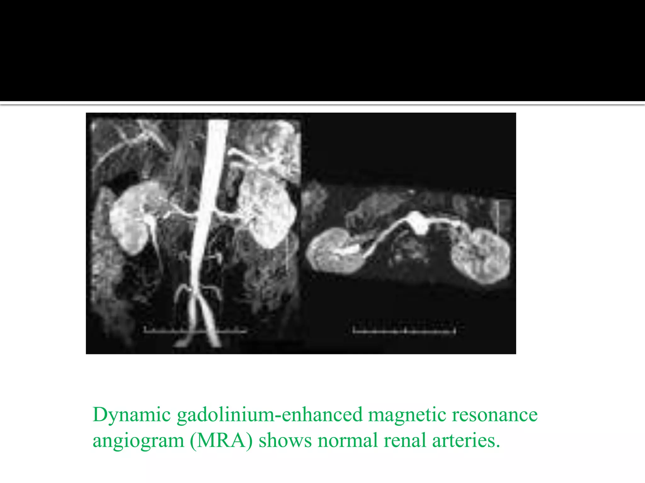 Imaging of renal hypertension | PPTX