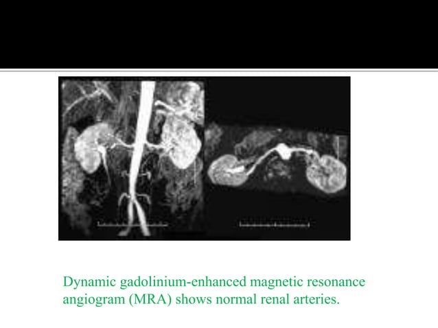Imaging of renal hypertension | PPTX