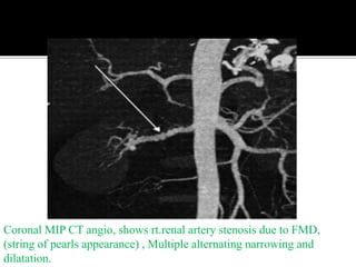 Imaging of renal hypertension | PPTX