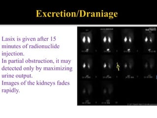 Imaging of renal hypertension | PPTX