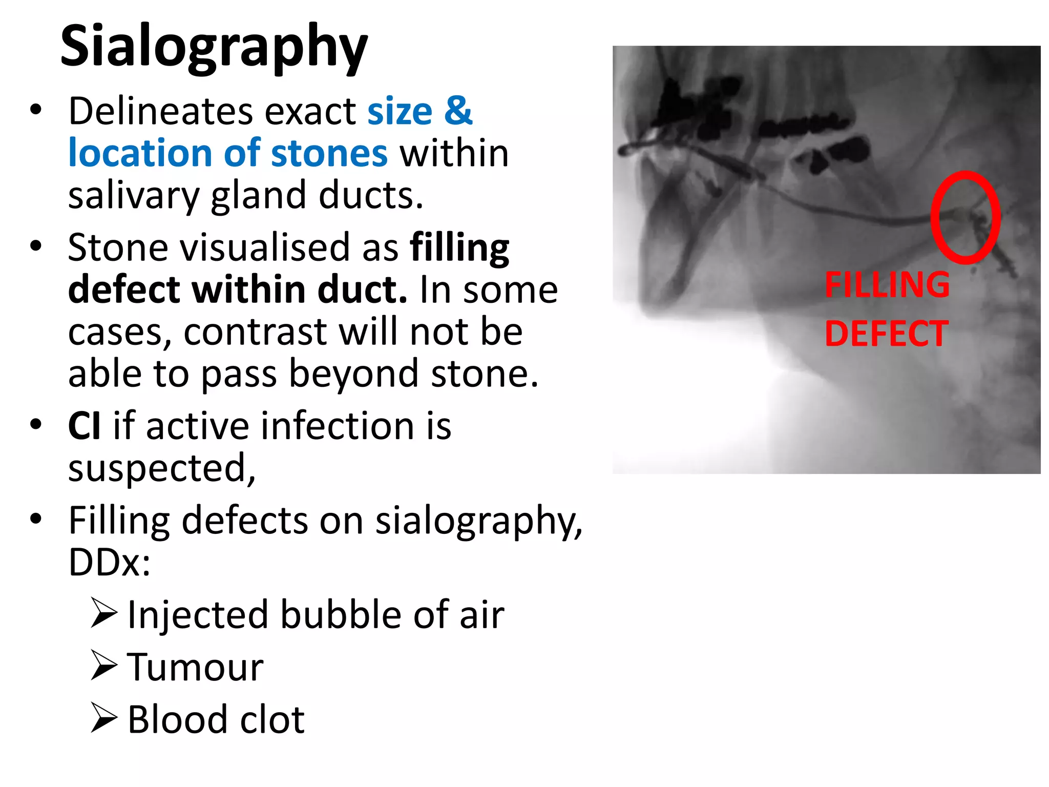 Imaging of salivary gland lesion | PPTX