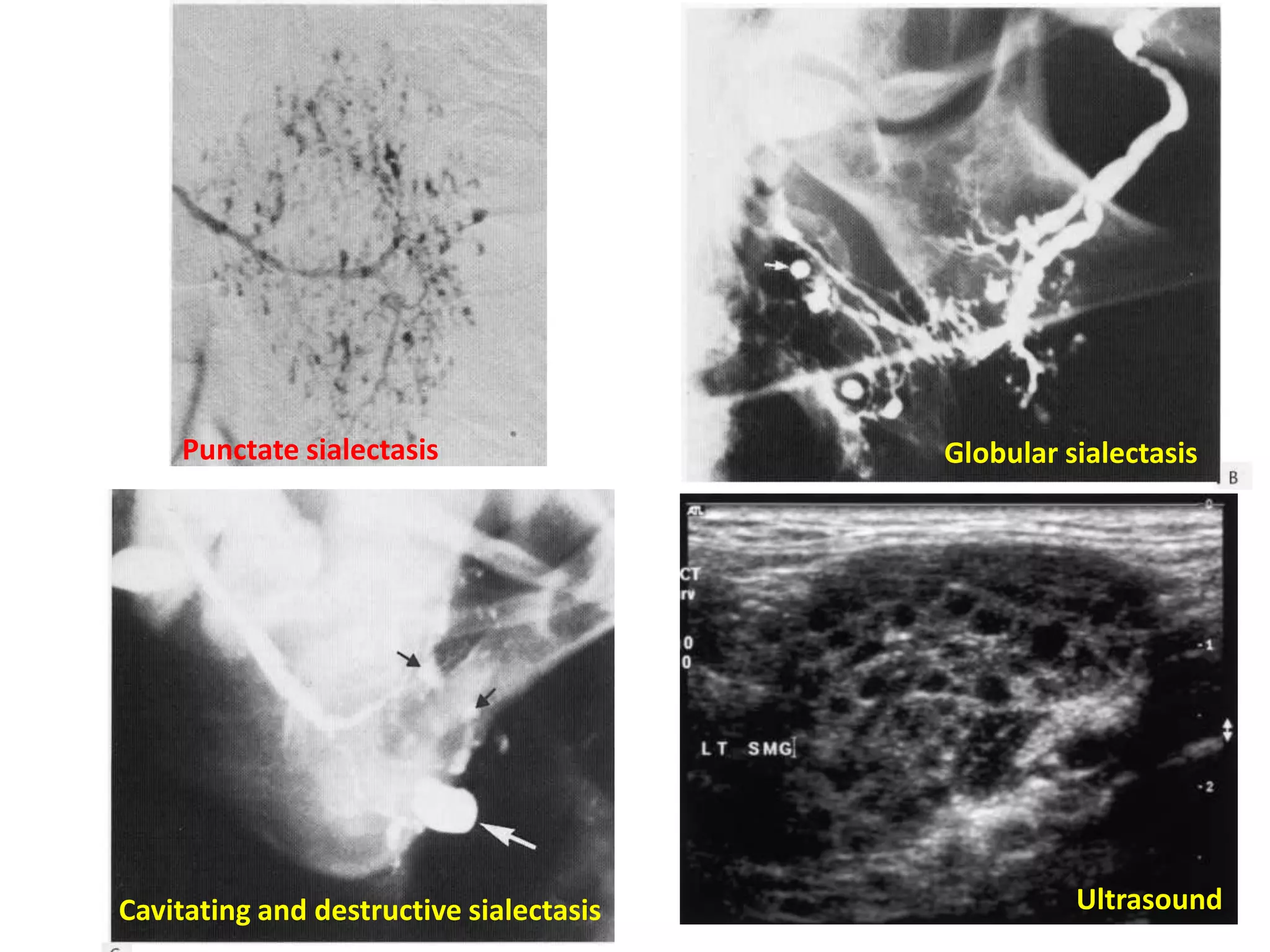 Imaging of salivary gland lesion | PPTX