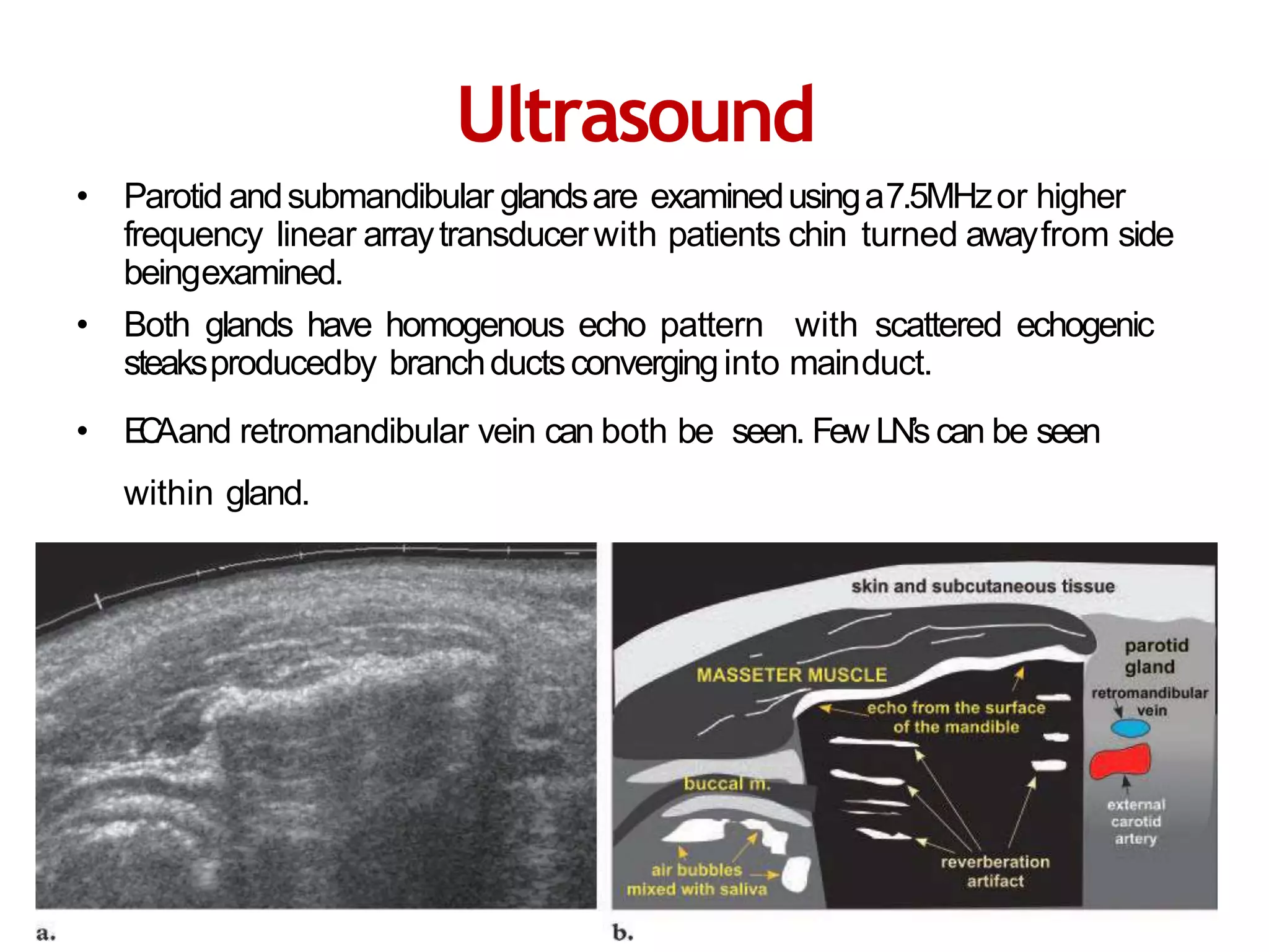 Imaging of salivary glands | PPTX