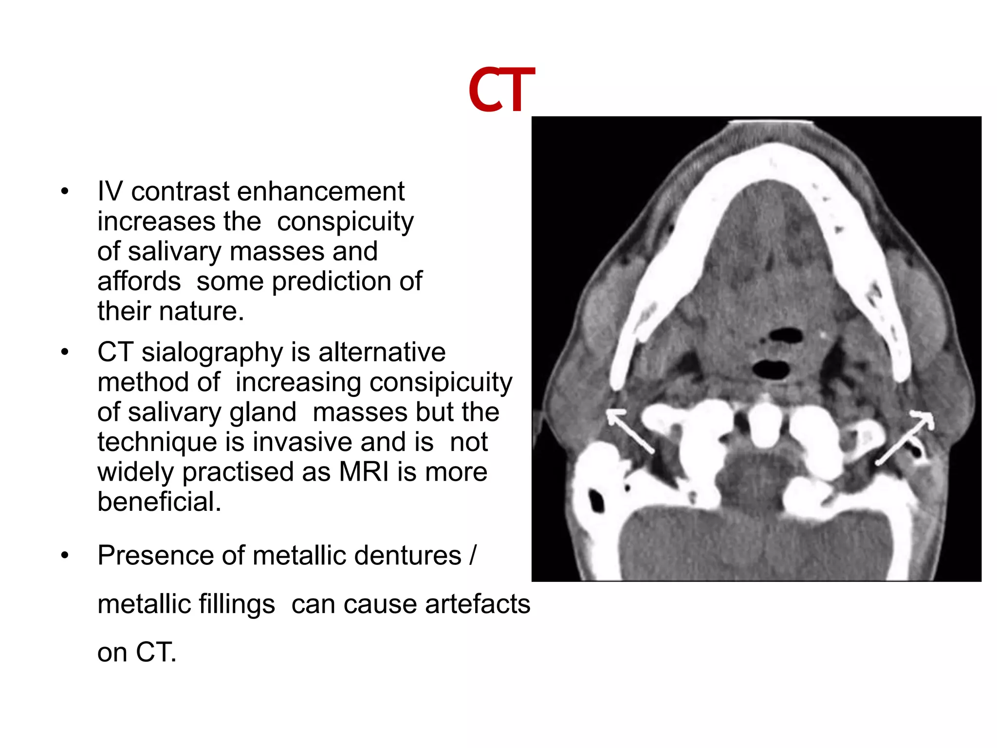 Imaging of salivary glands | PPTX