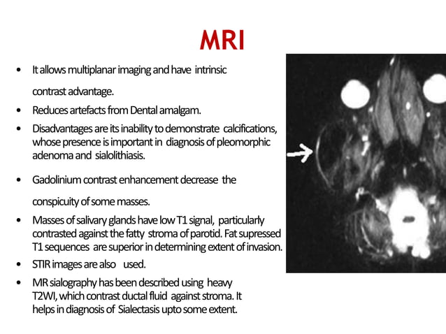 Imaging of salivary glands | PPTX