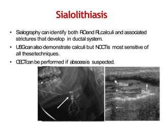 Imaging of salivary glands | PPTX