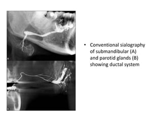 Imaging of salivary gland tumours | PPTX