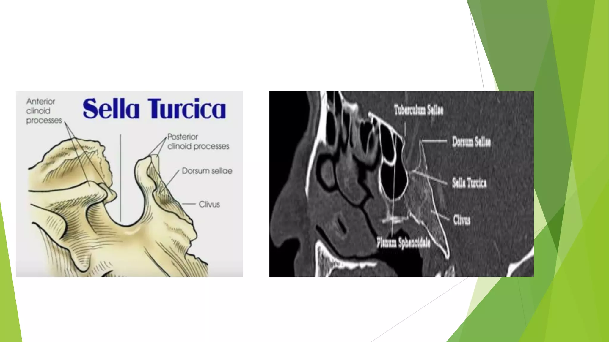 IMAGING OF SELLA AND SELLAR LESIONS MONICA.pptx